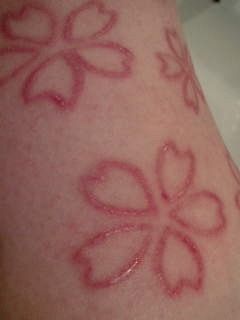 undermine scarification